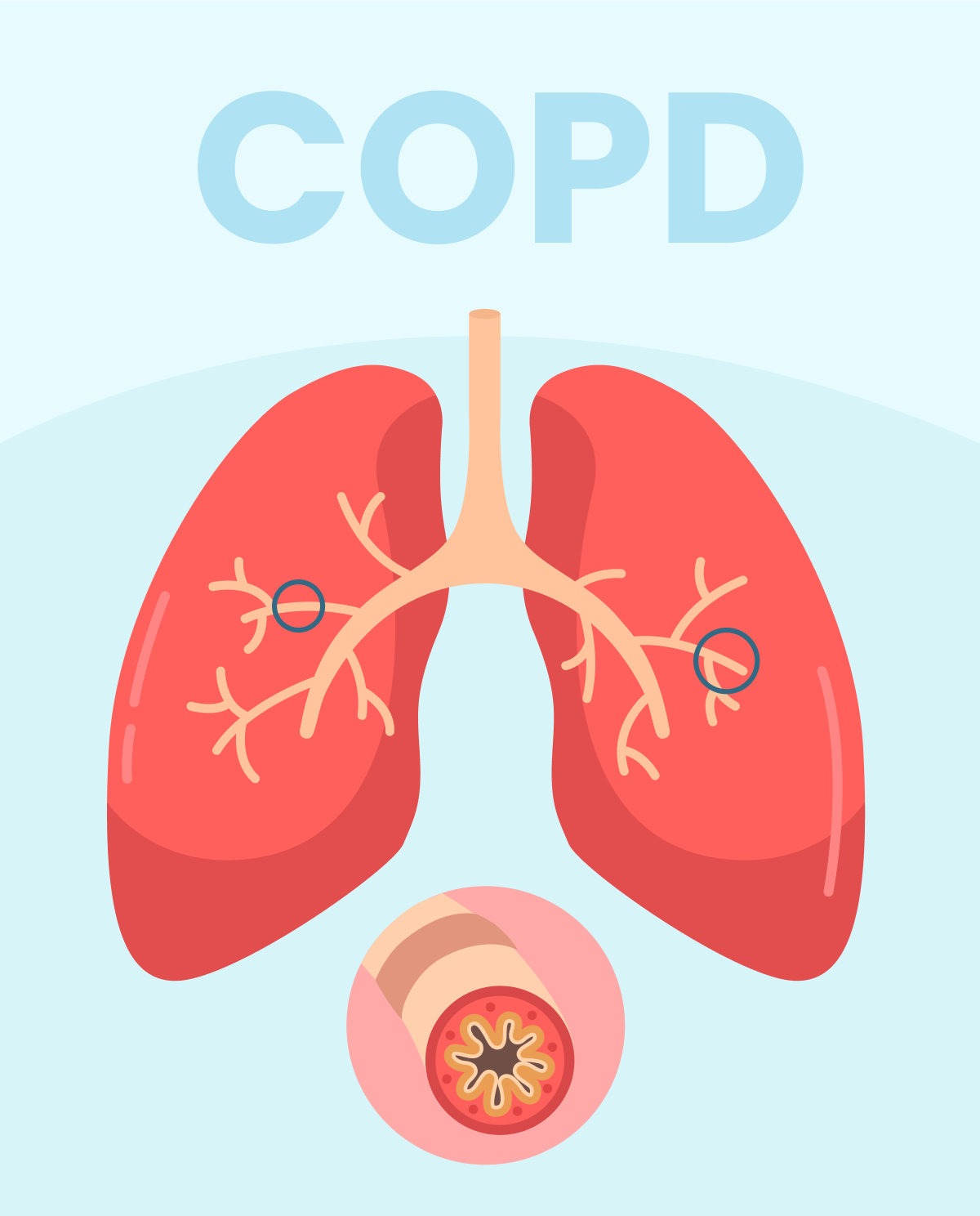 Chronic Obstructive Pulmonary Disease SynappseHealth Chronic Obstructive Pulmonary Disease SynappseHealth